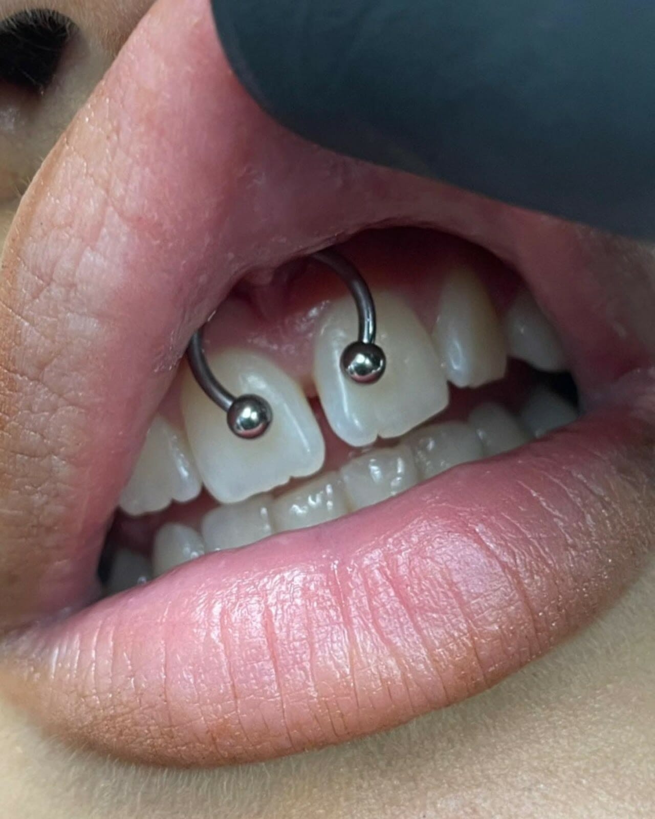 Infected Smiley Piercing Meaning, Infections, And Aftercare - Psycho Tats