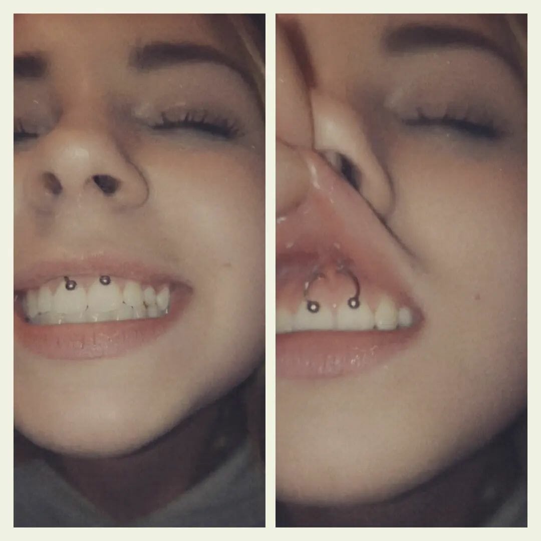 Infected Smiley Piercing Meaning, Infections, And Aftercare - Psycho Tats