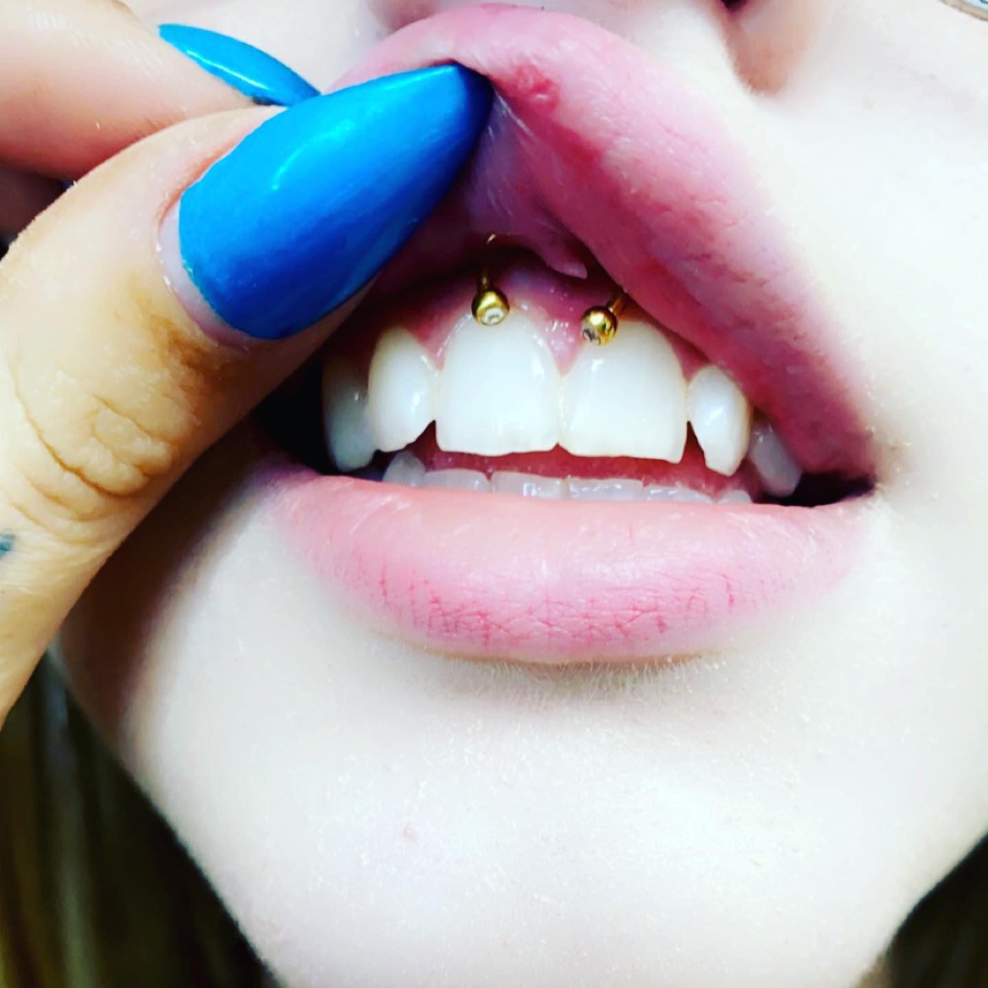 Infected Smiley Piercing Meaning, Infections, And Aftercare - Psycho Tats